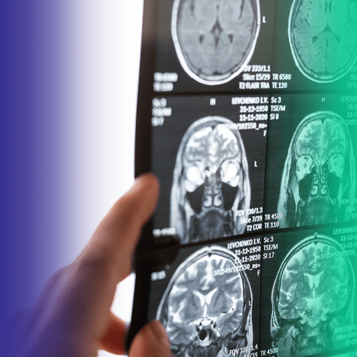 Hematoma Subdural: Como Identificar e Fazer o Diagnóstico